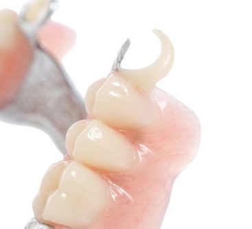 Prothèses adjointes - Laboratoire dentaire LMP